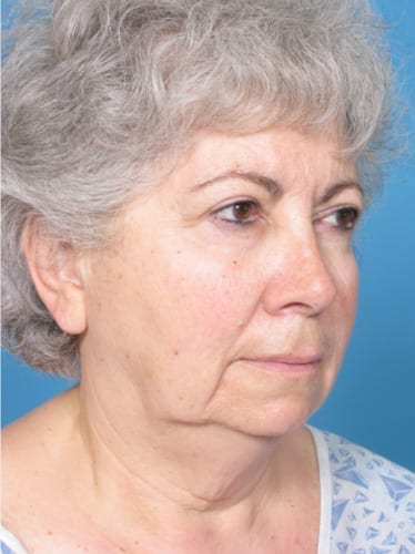 05Before-face-lift-dr-daniel-man-CDside5 | Dr. Man