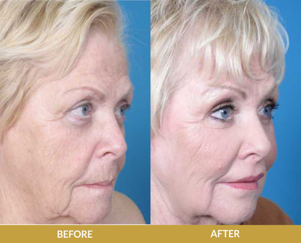 lip-lift-dr-daniel-man-sstside-2 | Dr. Man